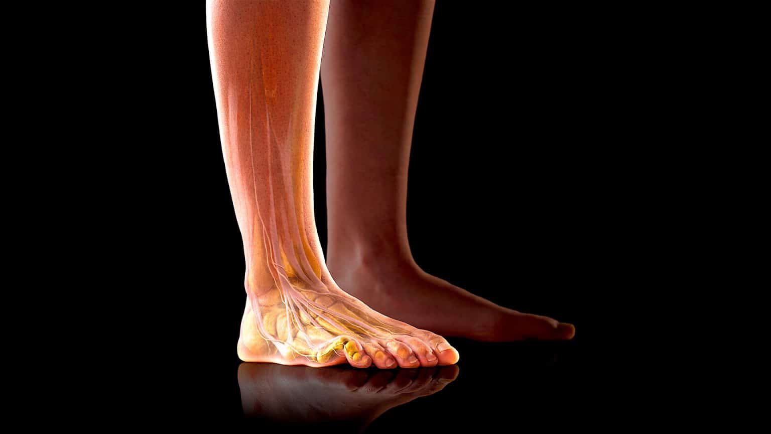 Pied en Pronation, c'est quoi ? Guide pour Coureurs et Sportifs